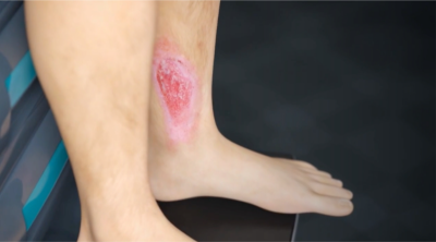 Úlceras venosas de la pierna